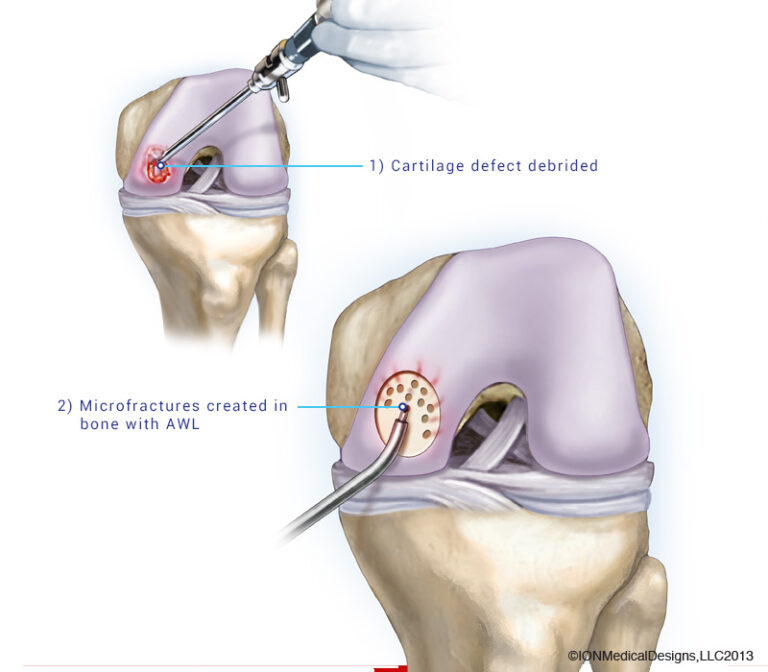 Microfracture surgery for Knee Osteoarthritis - Dr. Arun Reddy Mallu