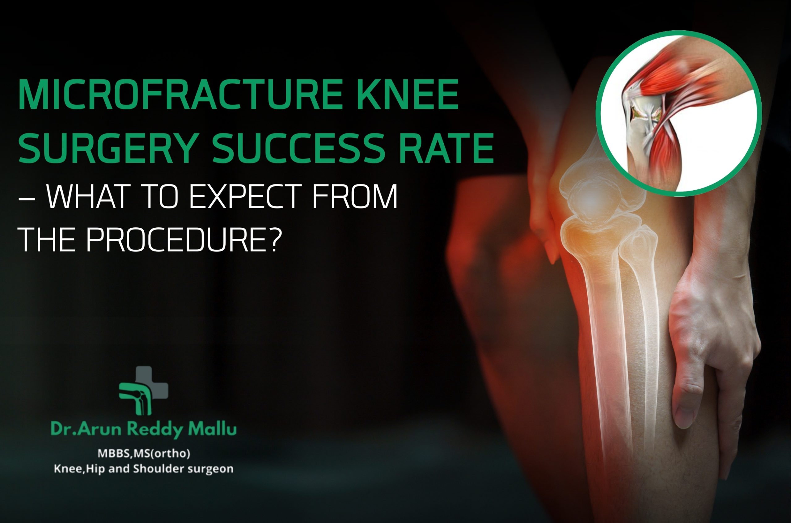 Microfracture Knee Surgery – Success Rate, Recovery & Expectations