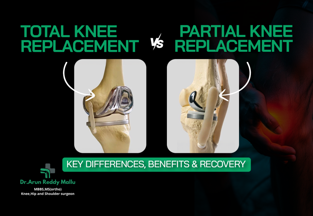 Total Knee Replacement vs Partial Knee Replacement – Differences ...